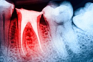 Sensitivity After A Root Canal: What's Normal? - 360 Dental